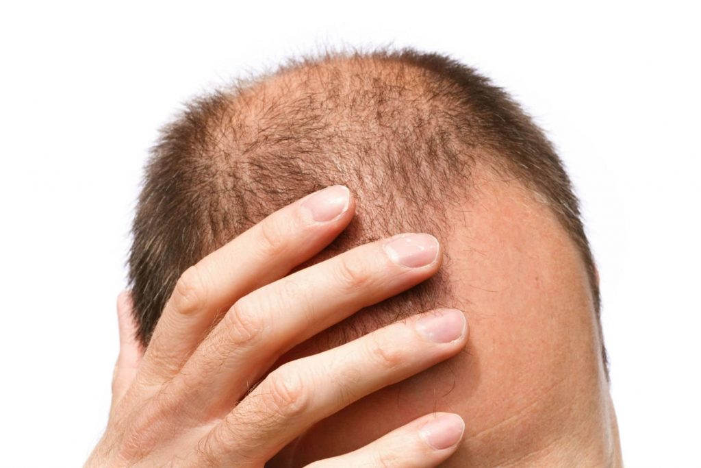Are You Going Bald? What To Do About Balding / Hair Loss | Advanced ...