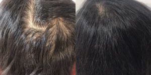 Advanced Hair Studio - Hair Loss & Regrowth Treatment Clinic Australia