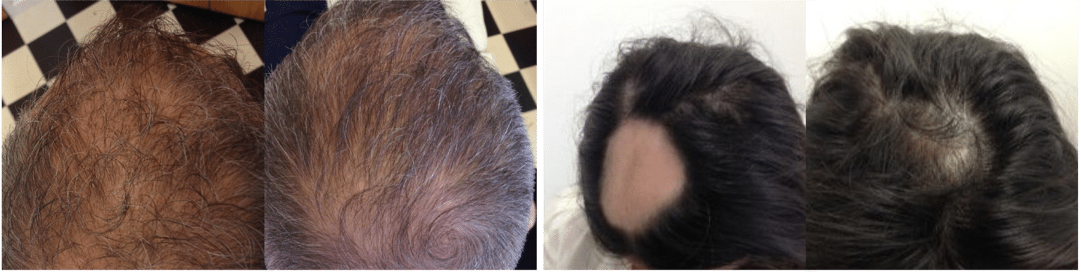STEM CELL INFUSED PRP Therapy - Hair Loss & Regrowth Treatment ...